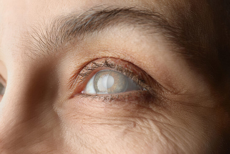 Cataract Surgery Livingston | Cataracts NJ | Associates in Ophthalmology